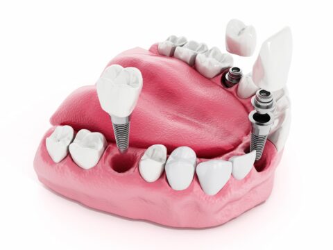 How Does a Tooth Implant Work? Ultimate Guide - Hanna Dental Implant Center
