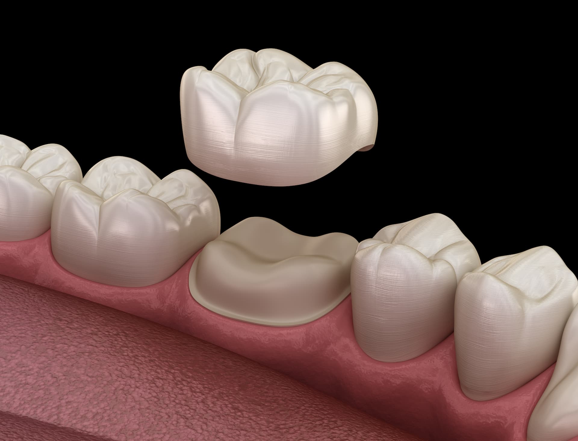Dental Implant vs. Crown: Which is the Right Choice for You? | Hanna ...