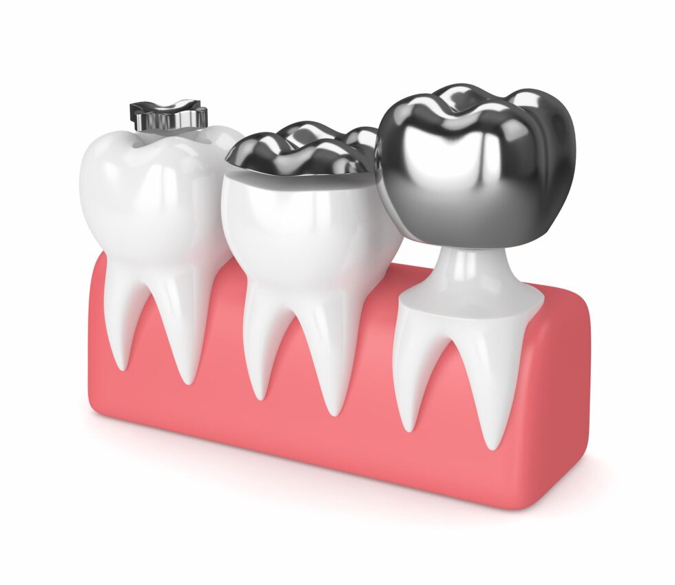 Dental Implant vs. Crown: Which is the Right Choice for You? - Hanna ...