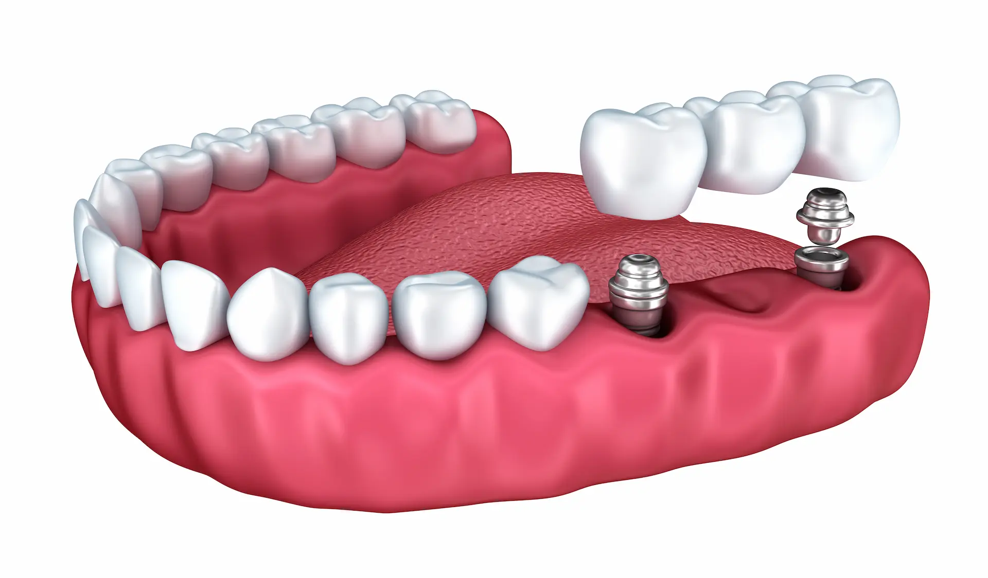 How Is a Crown Attached to a Dental Implant? - Hanna Dental Implant Center