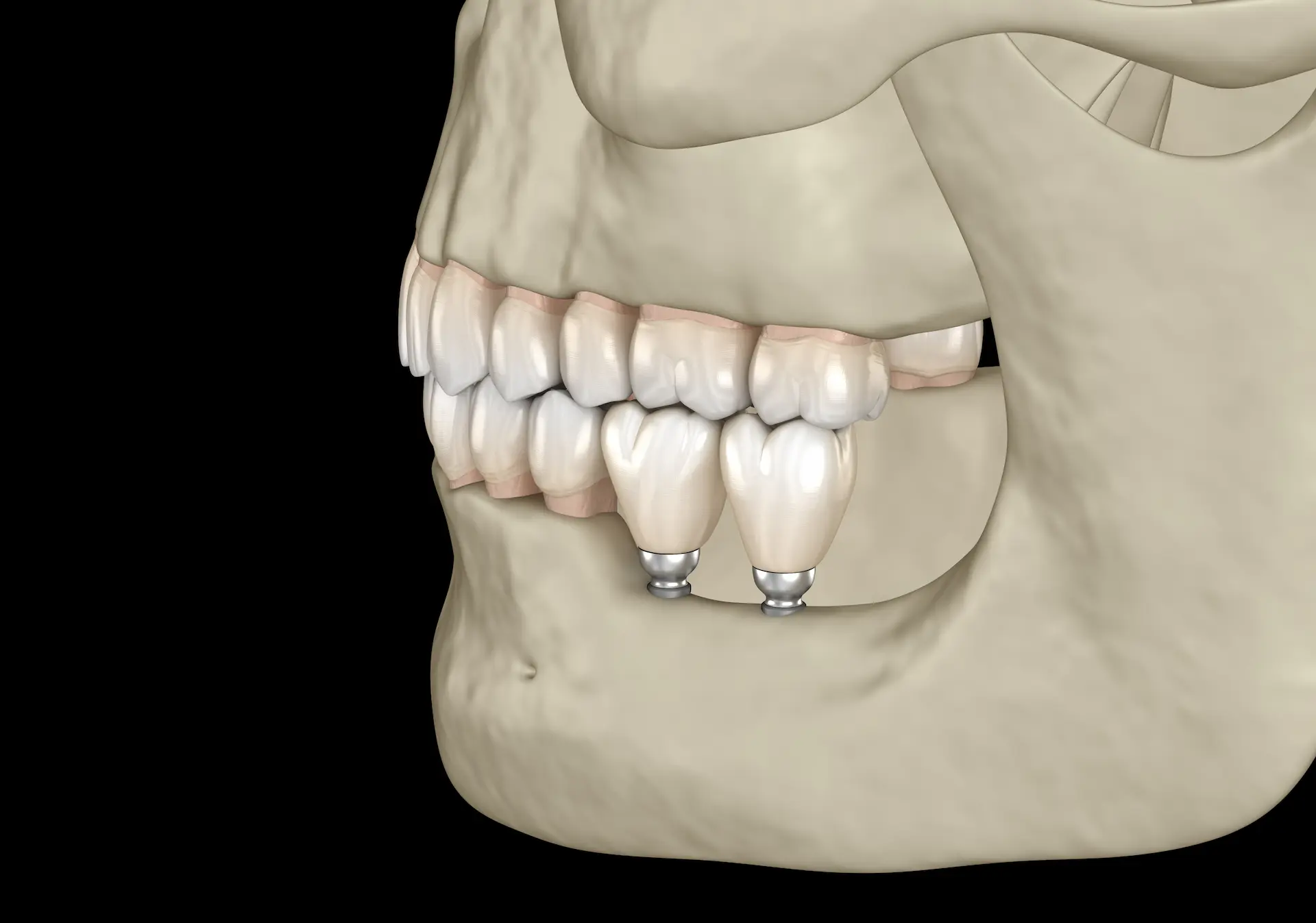 What are Mini Dental Implants? - Hanna Dental Implant Center