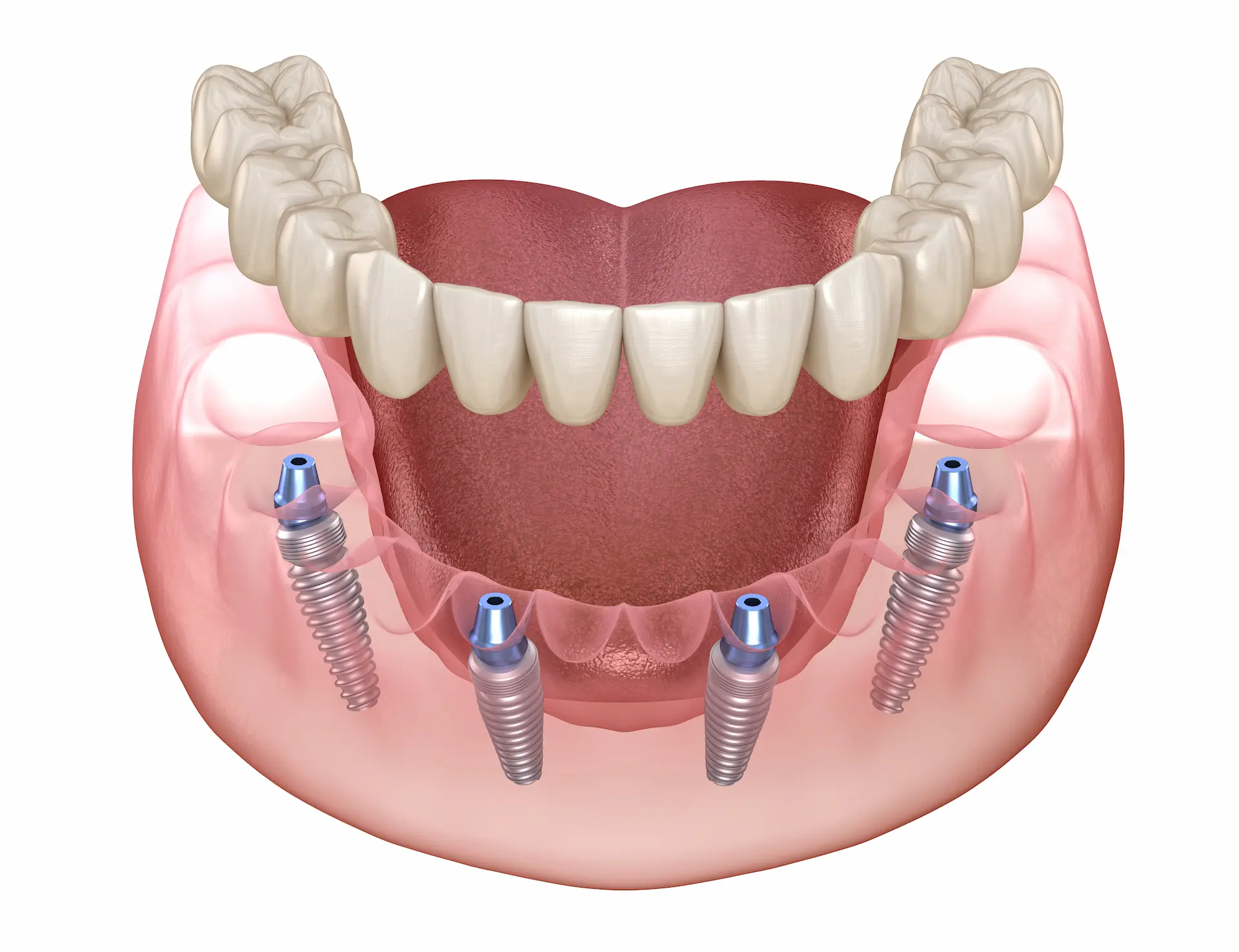 What is an All-on 4 Dental Implant? | Hanna Dental Implant Center
