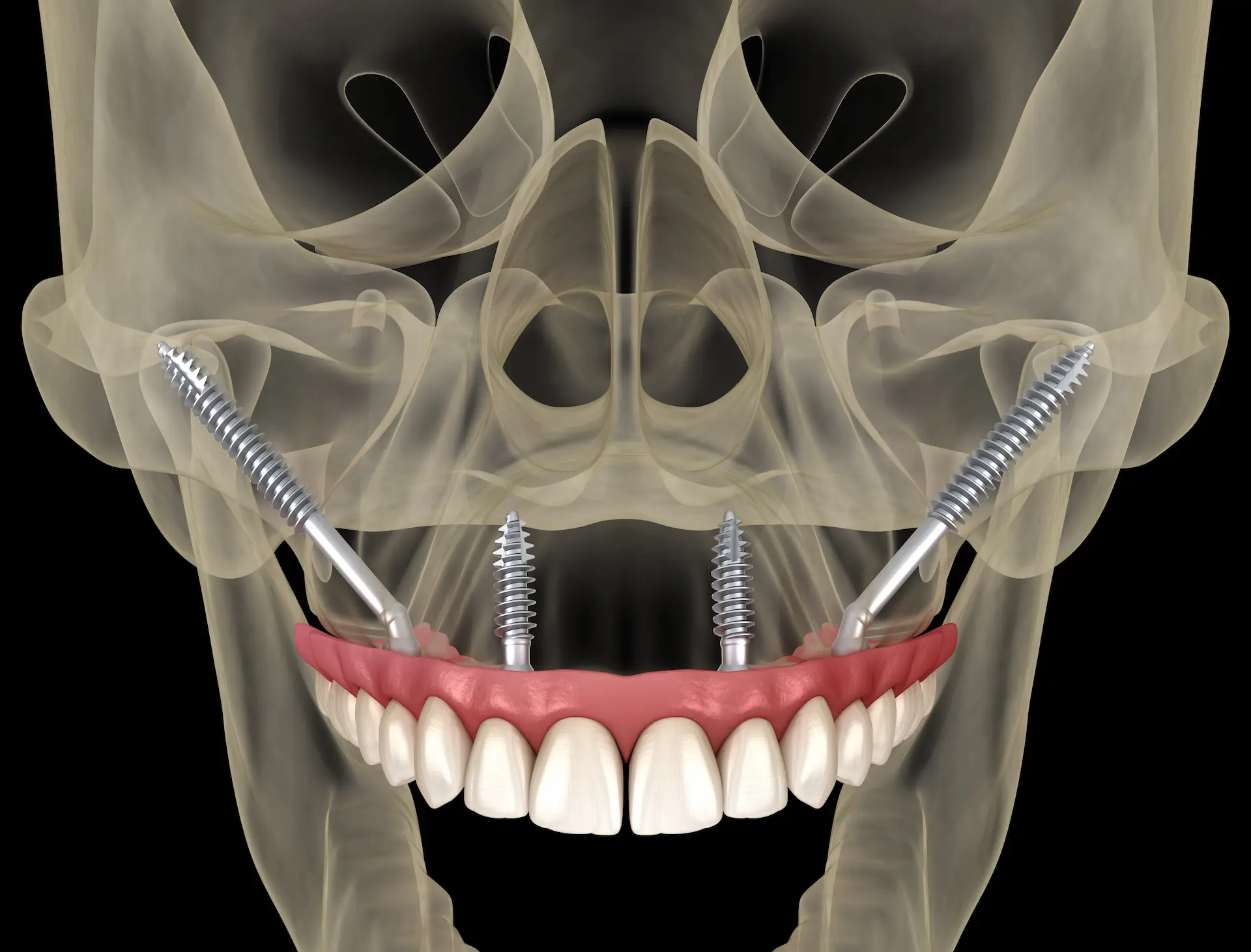 Zygomatic Implants: Everything You Need to Know | Hanna Dental Implant ...