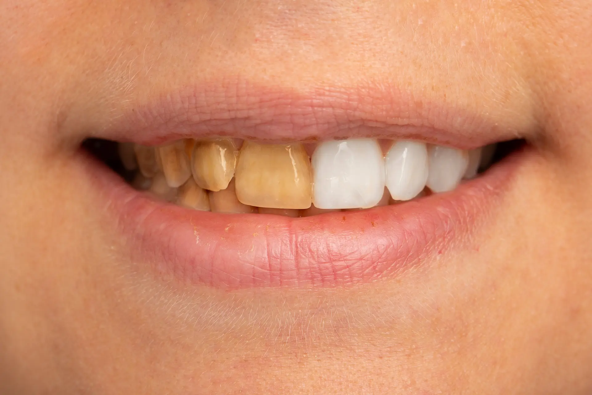 Stained Teeth: Causes, Prevention, and Professional Treatment Options ...